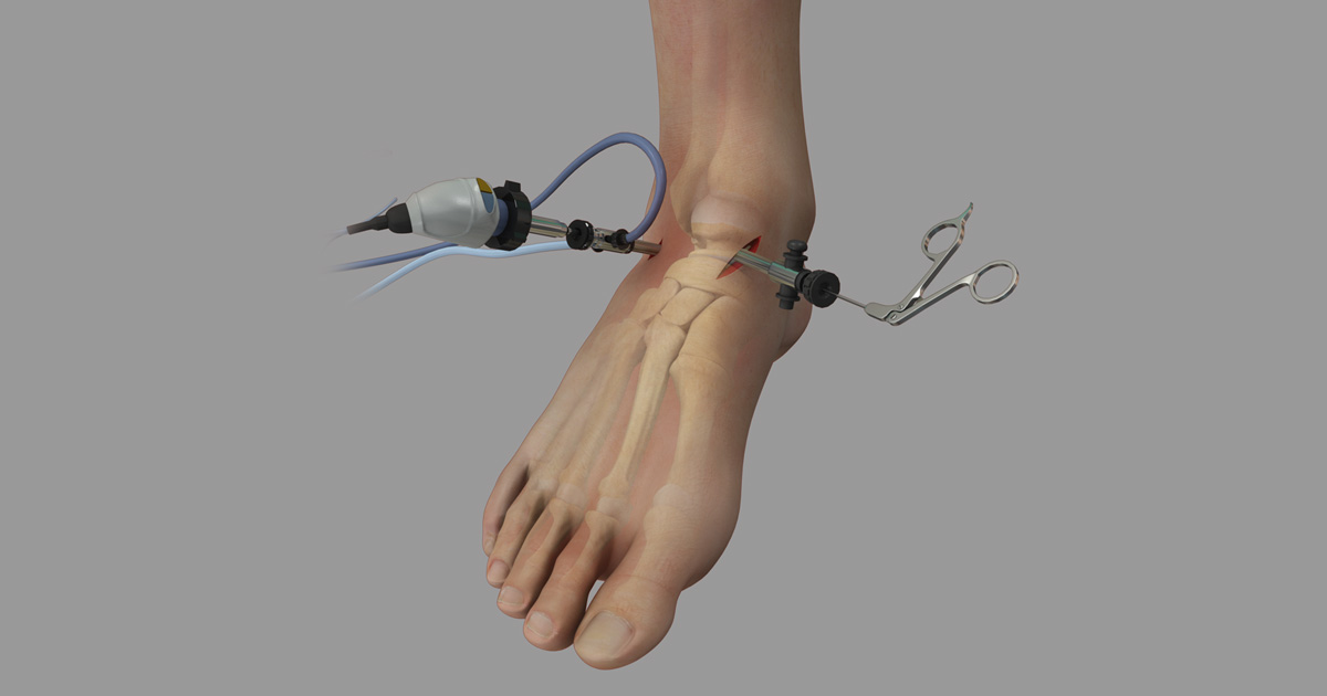 Ankle Arthroscopy San Diego, CA | Ankle Surgery Coronado, Carlsbad