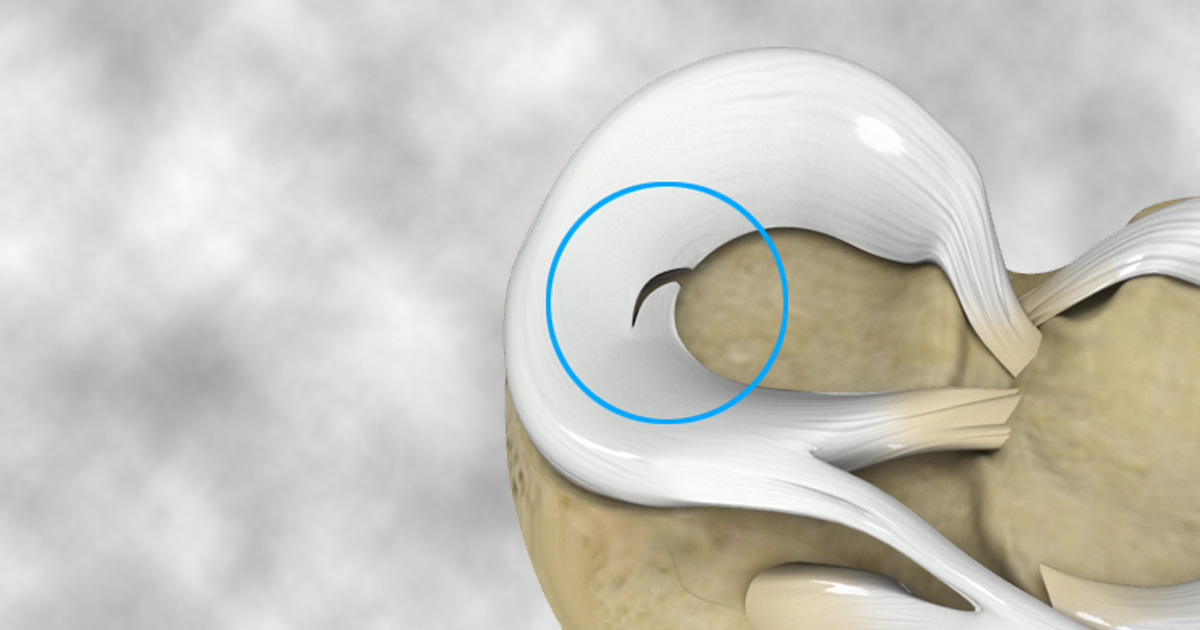 Meniscus Tear San Diego, CA | Meniscus Surgery Coronado, Carlsbad