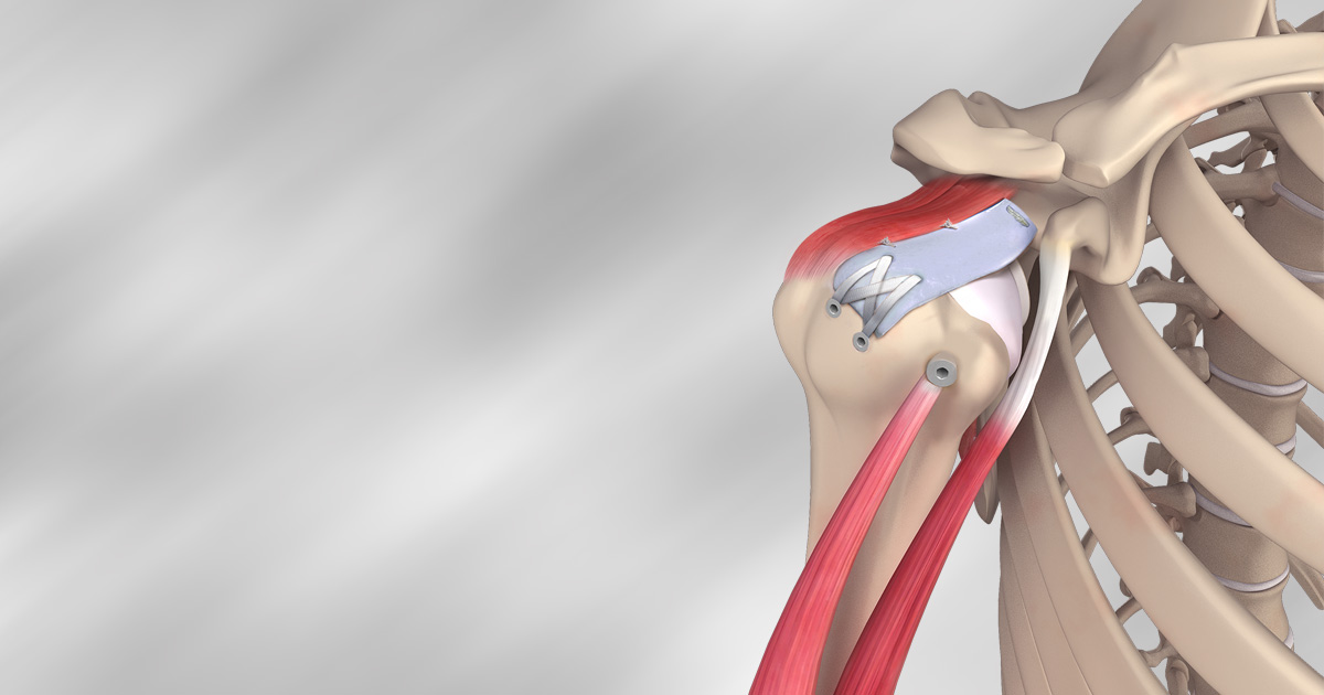 Shoulder Reconstruction vs. Shoulder Replacement